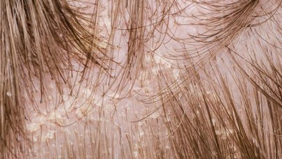 Hogyan szabadulj meg a korpától és a fejbőrön lévő pikkelyektől? | BIODERMA